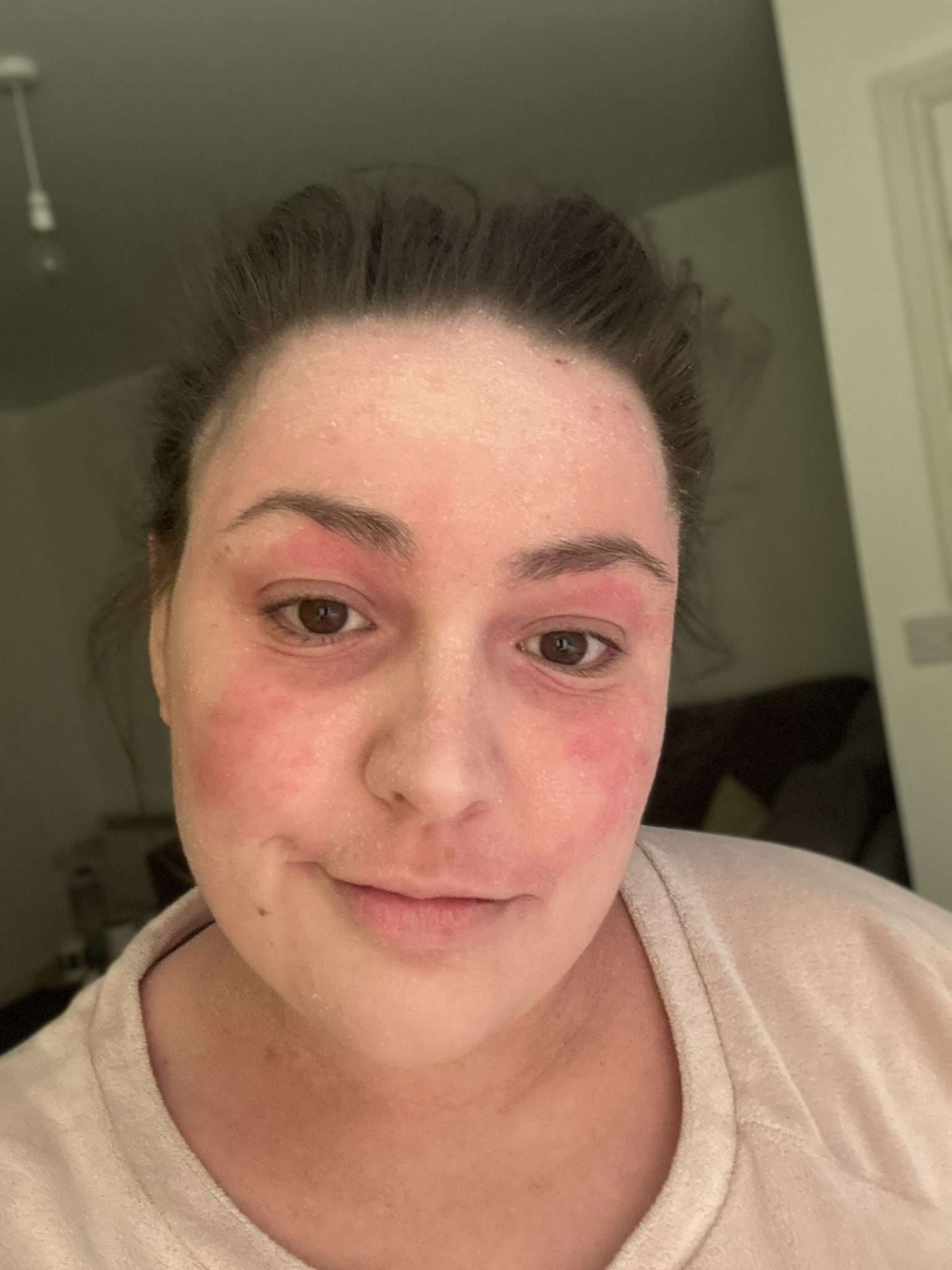 What is Eczema? CC’s Ultimate Guide to Itchy Skin! - The Itchy Coeliac